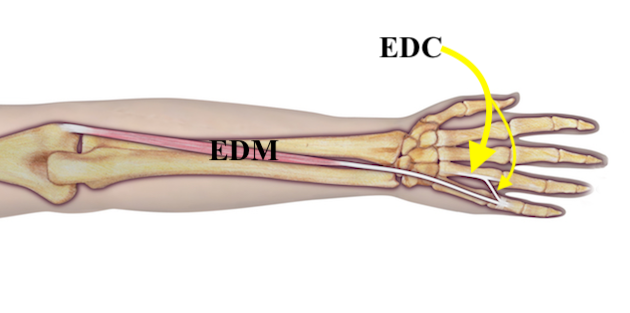 Extensor Digiti Minimi ( EDM ) Anatomy | Anatomic Structures at Risk