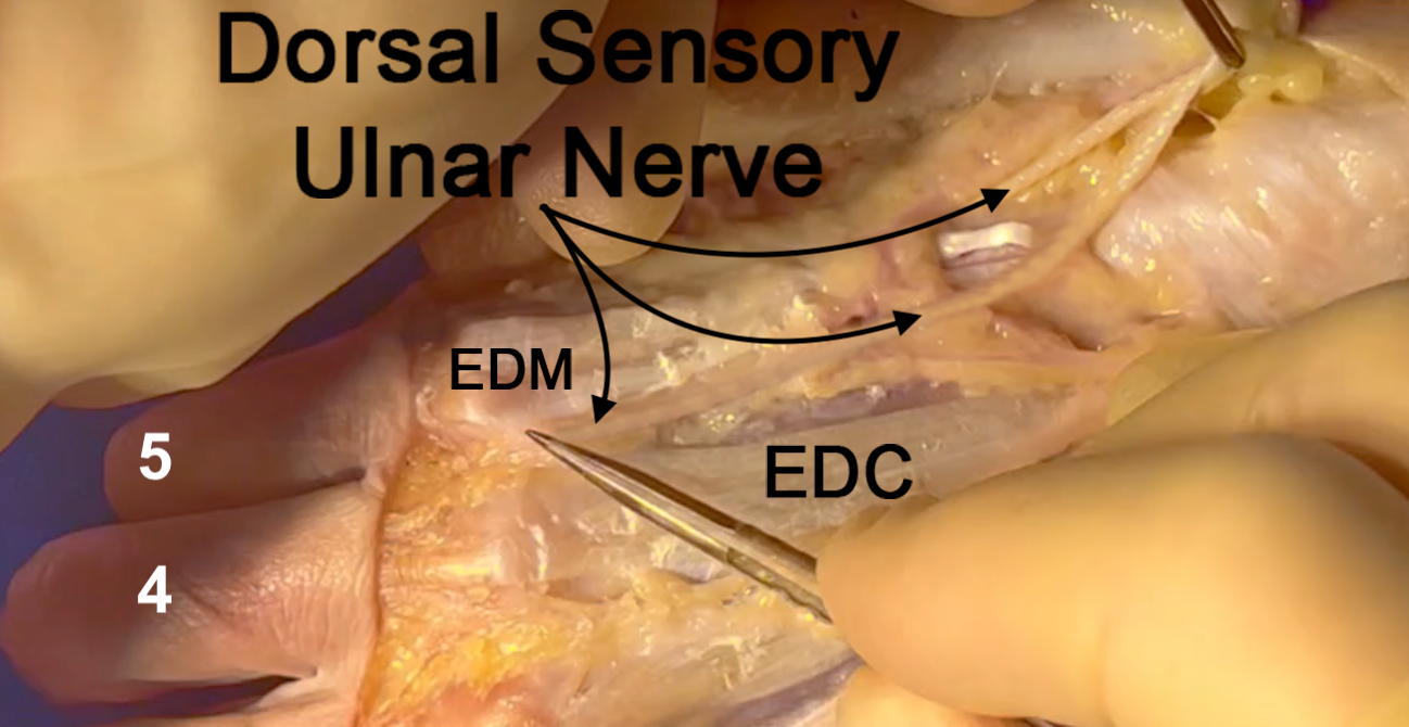 Dorsal Ulnar Sensory Nerve Anatomy | Anatomic Structures at Risk
