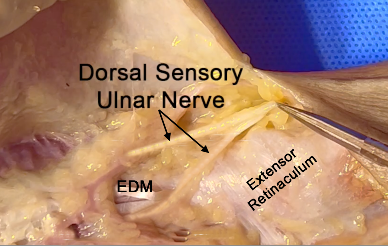 Dorsal Ulnar Sensory Nerve Anatomy | Anatomic Structures at Risk