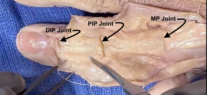 Proximal Interphalangeal Joint Anatomy | Anatomic Structures at Risk