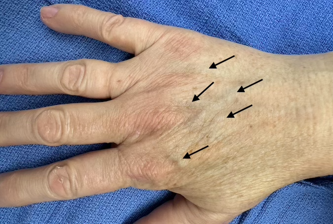 Dorsal Hand Veins Exam | Anatomic Structures at Risk