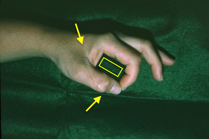 Adductor Pollicis Muscle Exam | Anatomic Structures at Risk