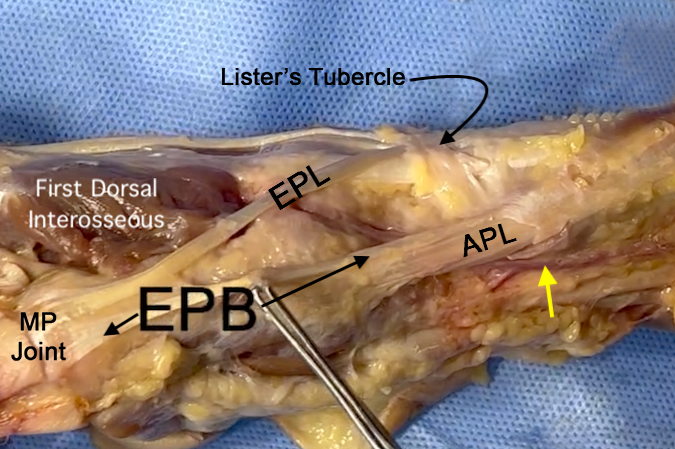 Abductor Pollicis Longus (APL) Anatomy | Anatomic Structures at Risk