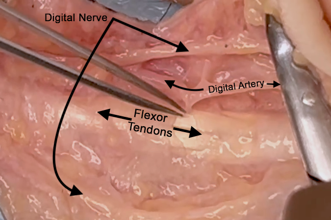 Little Ulnar Digital Nerve Anatomy | Anatomic Structures at Risk