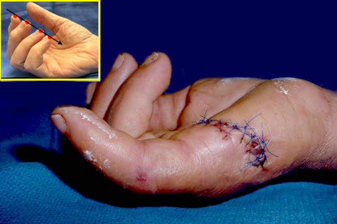 Little Flexor Digitorum Profundus Exam | Anatomic Structures at Risk