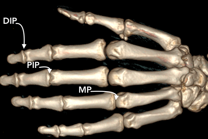 Little Proximal Interphalangeal (PIP) Joint Anatomy | Anatomic ...