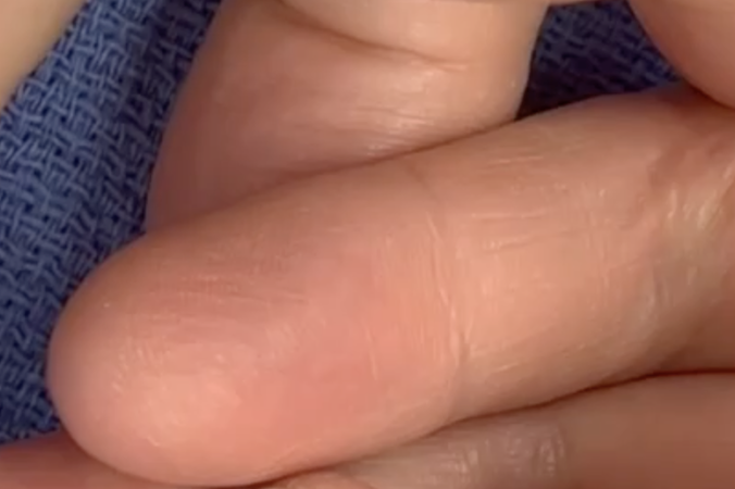 Common Digital Arteries in Second, Third and Fourth Webs and Vein Exam ...