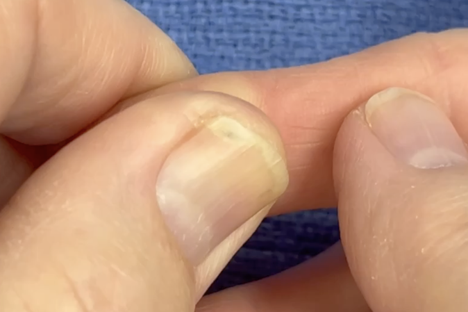 Radial and Ulnar Digital Arteries Index, Long, Ring and Little and Vein ...