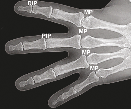 MP Joints Index, Long, Ring and Little Exam | Anatomic Structures at Risk