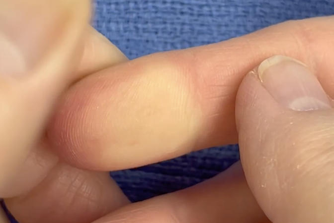 Common Digital Arteries in Second, Third and Fourth Webs and Vein Exam ...