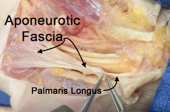 Palmar Skin Retention Ligaments | Anatomic Structures at Risk