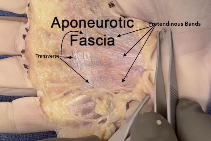 Palmar Skin Retention Ligaments | Anatomic Structures at Risk
