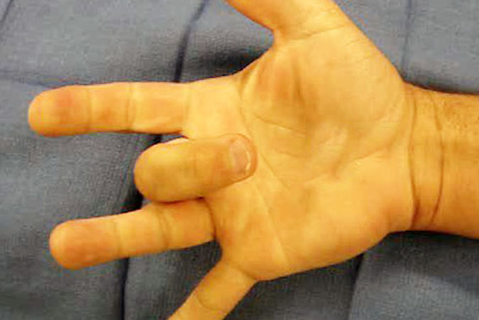 Index, Long, Ring and Little Flexor Sheaths Exam | Anatomic Structures ...