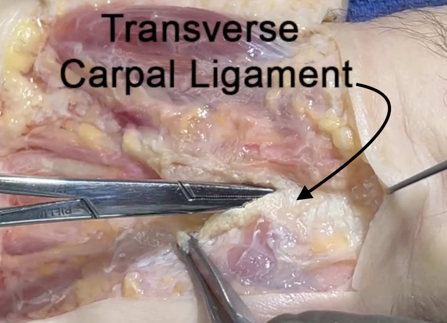 Median Nerve in Carpal Tunnel | Anatomic Structures at Risk